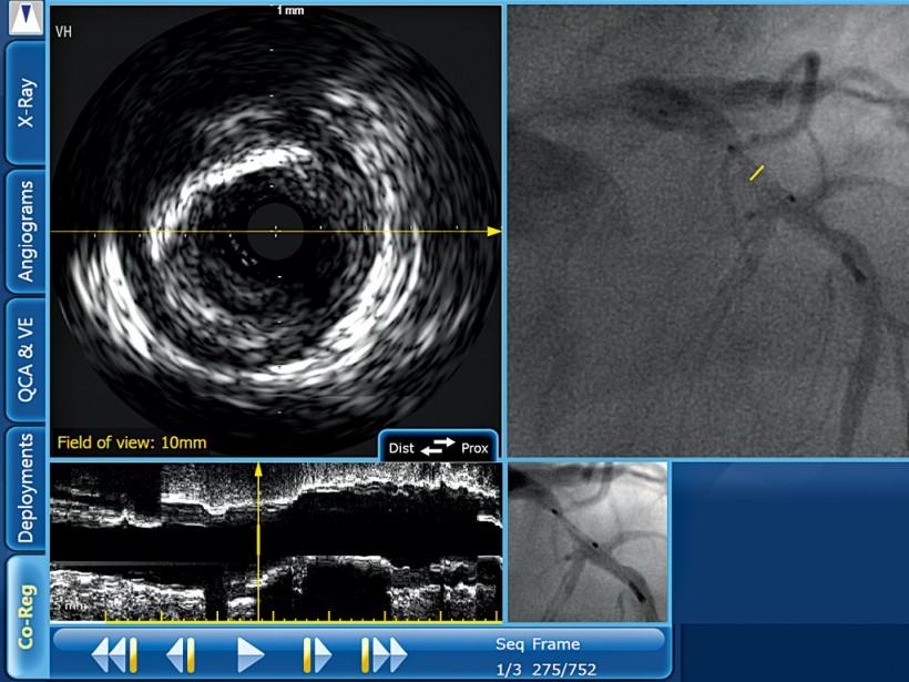 Volcano Europe’s imaging technologies help cut heart disease – The New ...