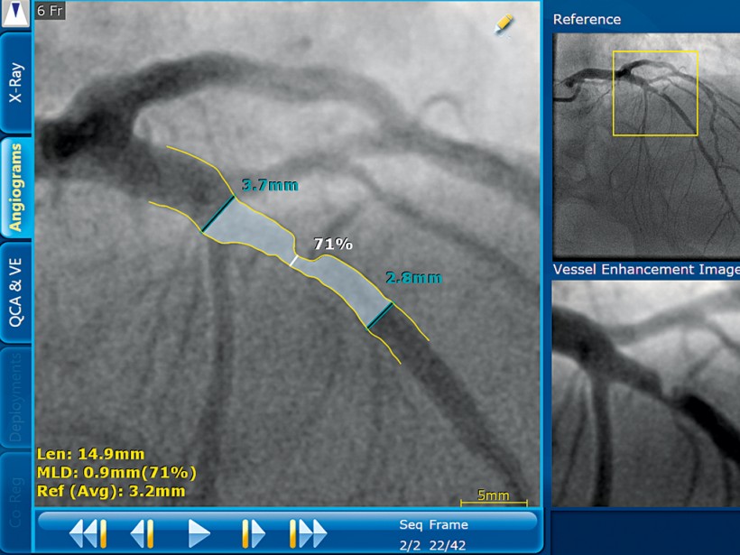 Volcano Europe’s imaging technologies help cut heart disease – The New ...